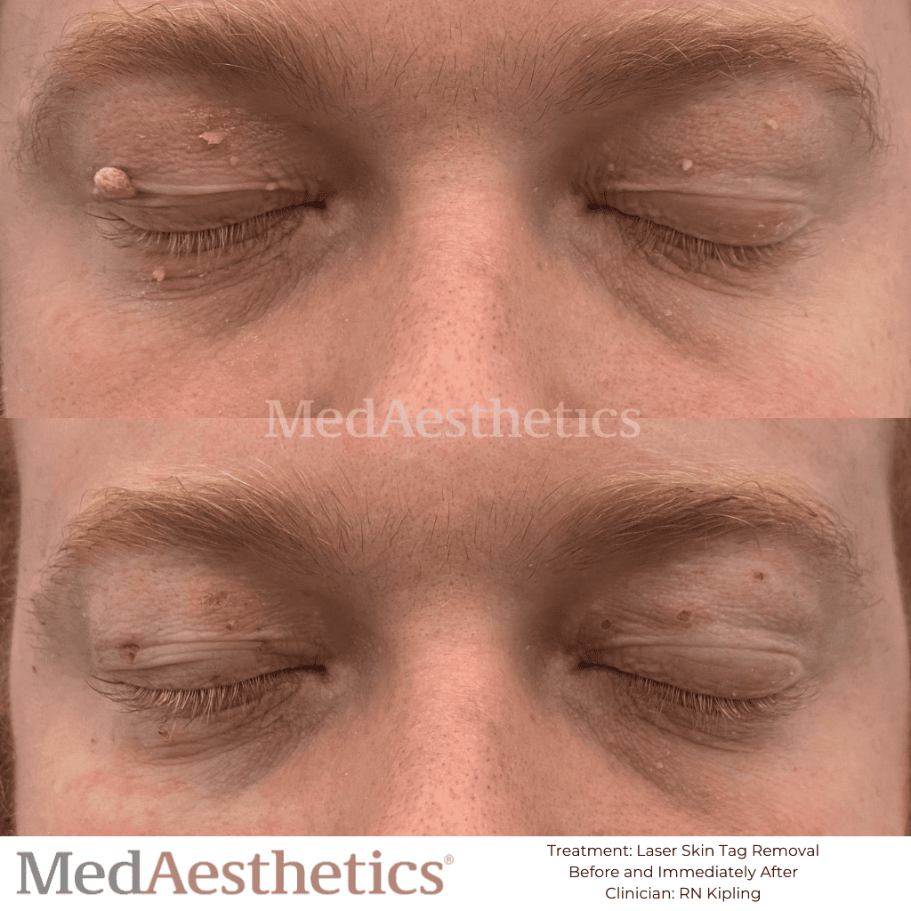 Laser Skin Tag Removal | MedAesthetics